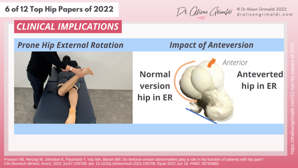 Femoral version and hip function | 6 of 12 Top Hip Papers of 2022