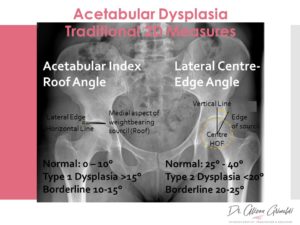 Acetabular Dysplasia - seeing the whole picture | Dr Alison Grimaldi
