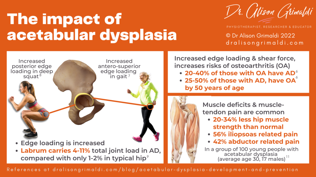Acetabular Dysplasia: Development and Prevention | Find out more