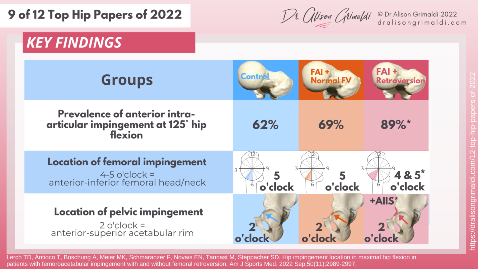 Femoral retroversion and impingement location in FAI | 9 of 12 Top Hip ...